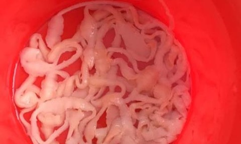 Con sán xơ mít dài 9m trong bụng một thanh niên